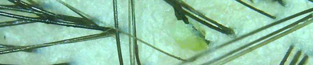 For Excess Sebum | Rebalancing - Scalp Overview and Treatment Options ...